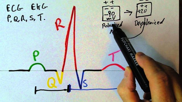 Understanding the Significance of a Notched T Wave in ECG Readings